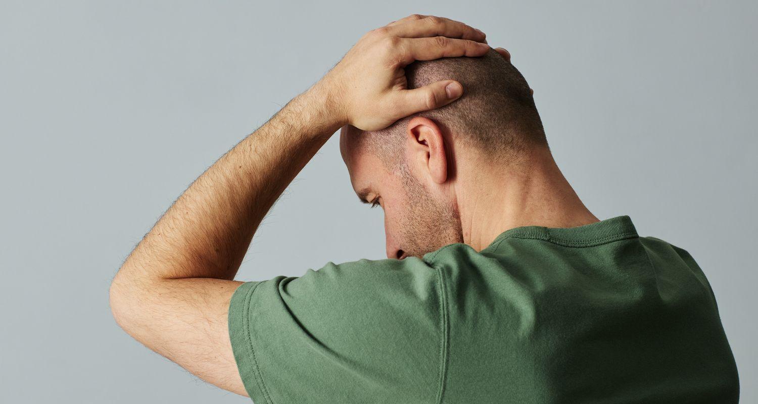 Low Testosterone and Hair Loss | The Sanctuary