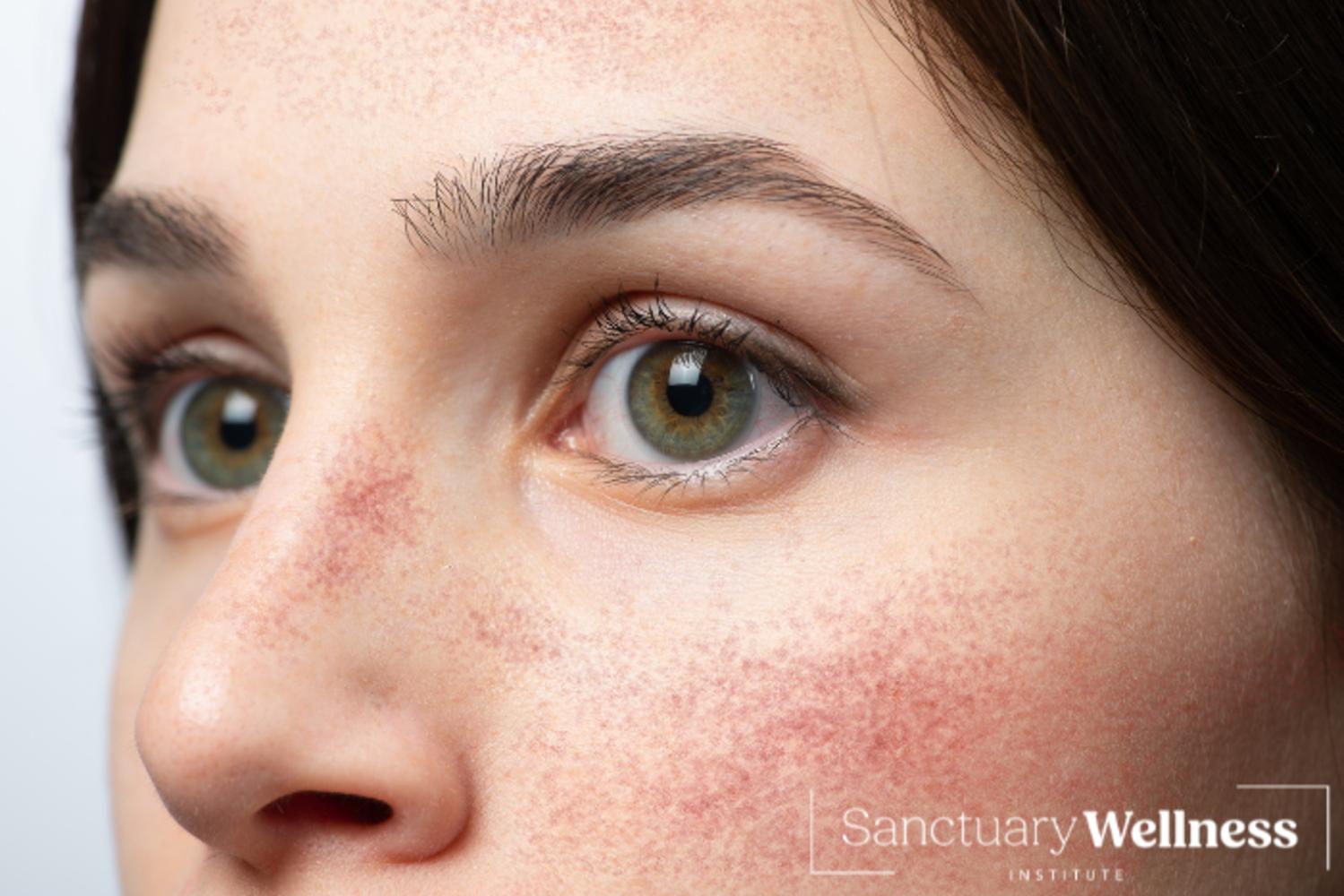 Medical Marijuana for Stroke Recovery | The Sanctuary